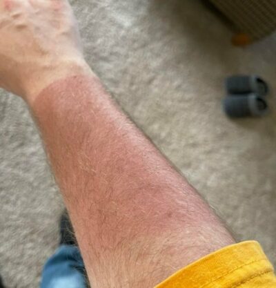 25 Personas “quemadas” que arruinaron su bronceado