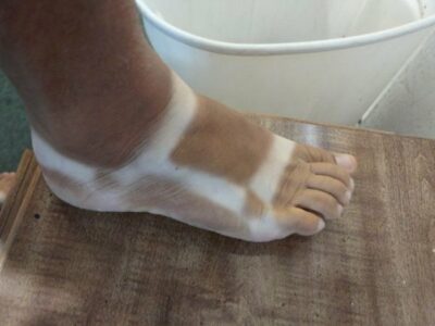 25 Personas “quemadas” que arruinaron su bronceado
