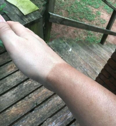 25 Personas “quemadas” que arruinaron su bronceado