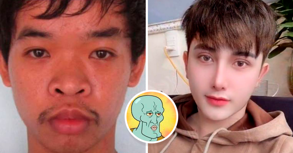 Se cansa de que le digan feo y se opera, ahora luce muy diferente